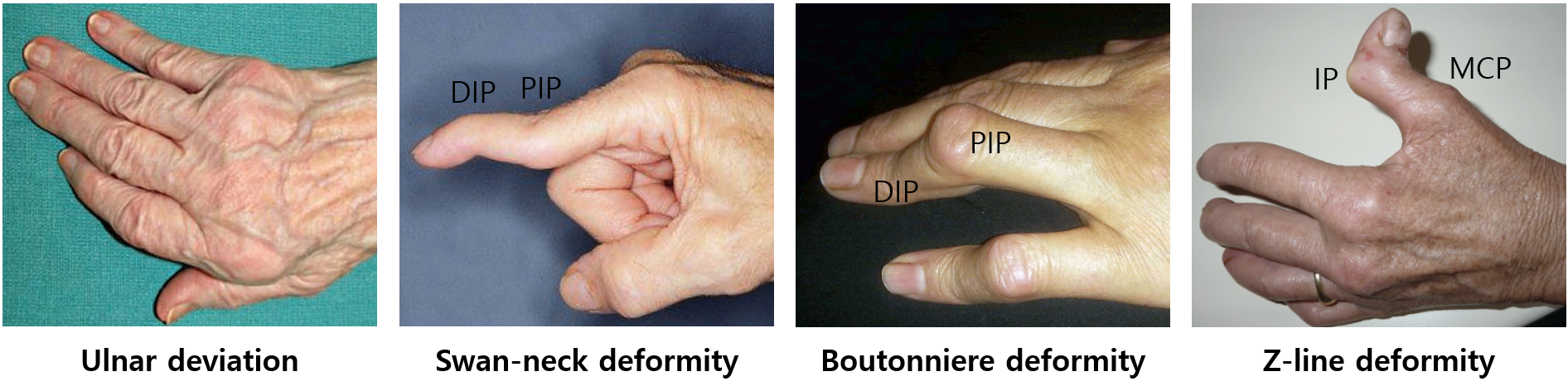 류마티스 | 류마티스관절염 | 류마티스 관절염 | 알렌의 서재