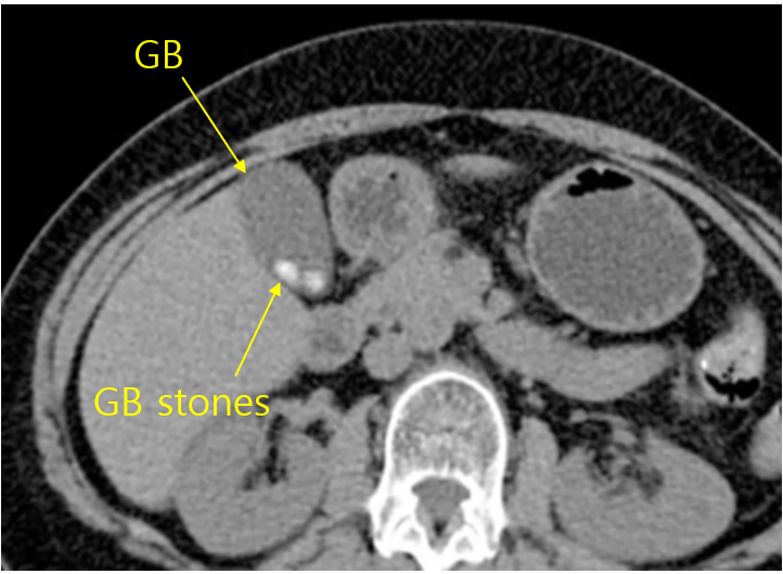 RES 내과 | 소화기 | 간담췌-담도질환 - 담석증 | 알렌의 서재