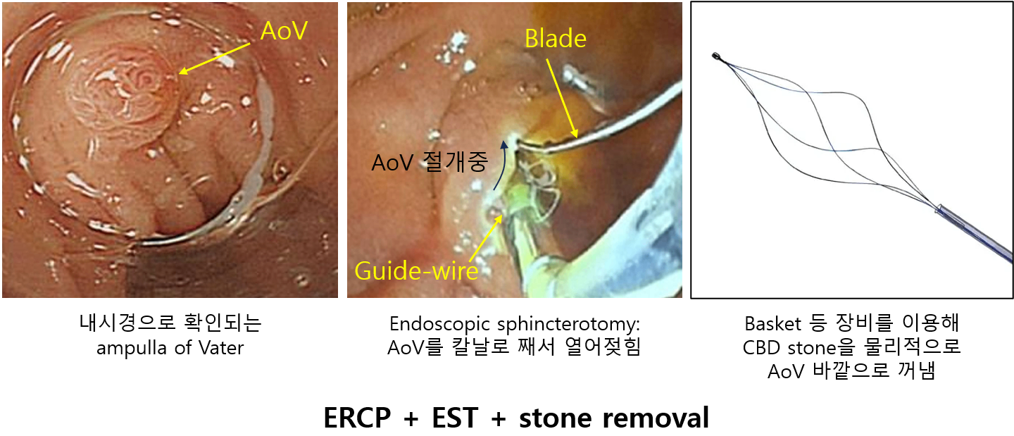 외과각론 | 담도 | 총담관담석증과 담관염 | 알렌의 서재