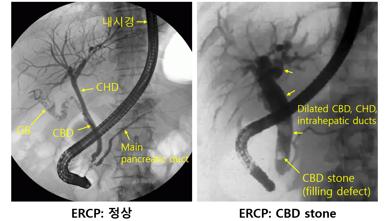 외과각론 | 담도 | 총담관담석증과 담관염 | 알렌의 서재