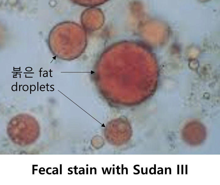 RES 내과 | 소화기 | 간담췌-이자질환 - 만성 췌장염 | 알렌의 서재