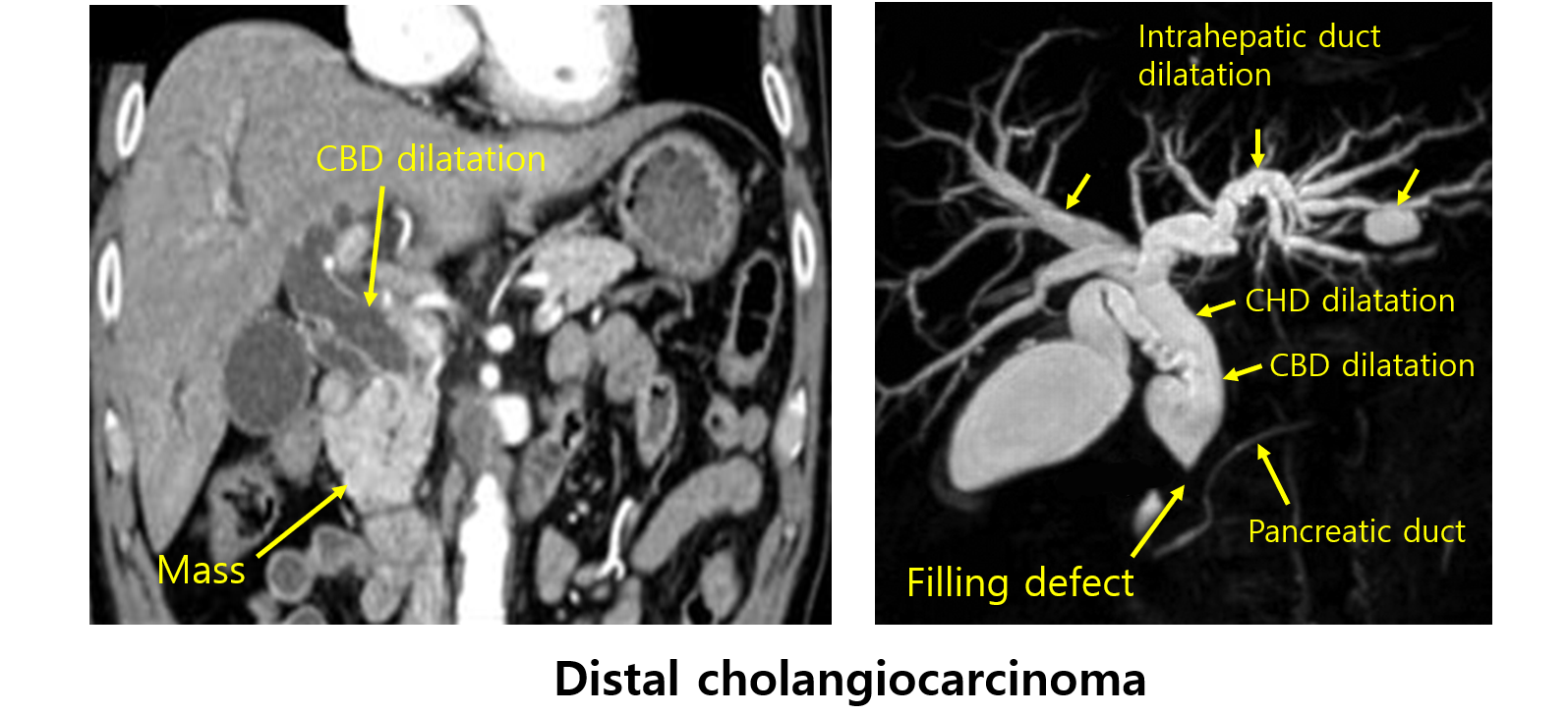 RES 내과 | 소화기 | 간담췌-담도질환 - 담관암 | 알렌의 서재