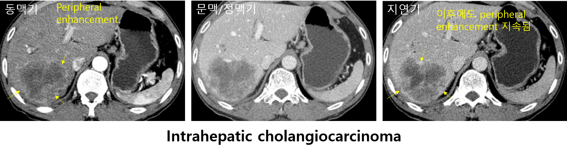 소화기 | 간담췌-담도질환 | 담관암 | 알렌의 서재