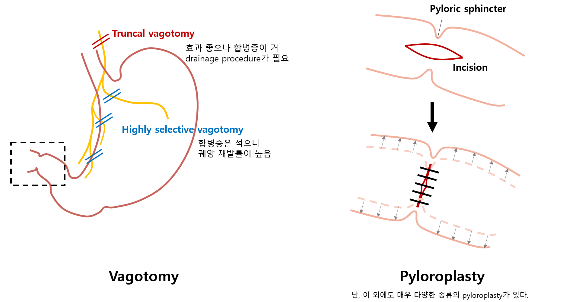 RES 외과 | 외과 각론 | 위 식도 샘창자 - 상부위장관 양성질환 | 알렌의 서재