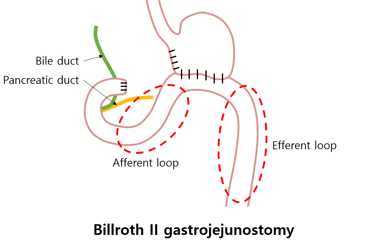 외과각론 | 위 식도 샘창자 | 위절제술 후 증후군 | 알렌의 서재