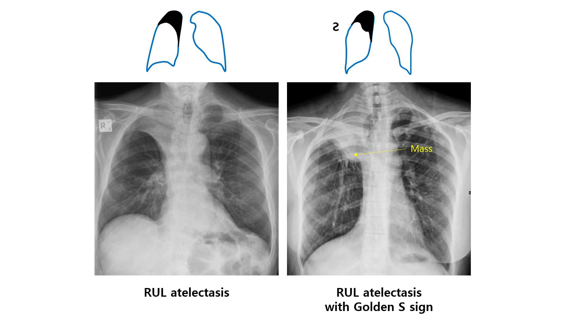 호흡기 | 폐질환 검사법 | 흉부 X선 검사 및 무기폐 | 알렌의 서재
